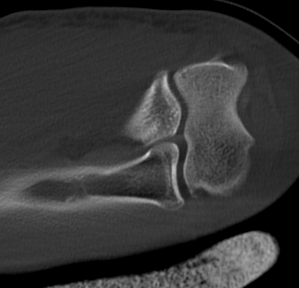 Multidirectional instability following posteromedial elbow dislocation