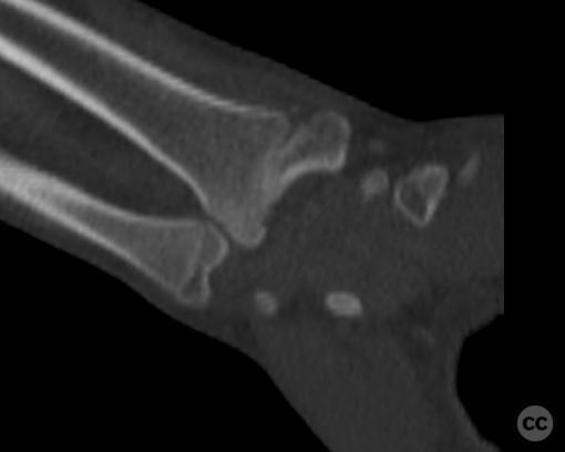 Malunion Salter III distal radius fracture dislocation