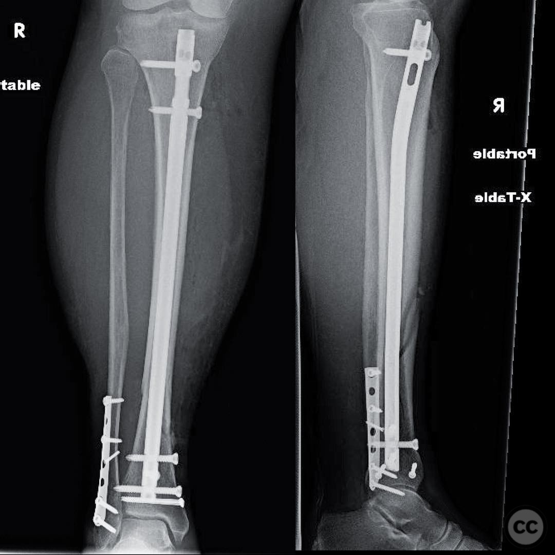 Distal Tibial Metaphyseal Fracture with Non-displaced Medial Malleolar ...