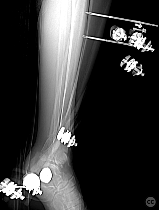 High-energy tibia and fibular fracture following a motorcycle accident