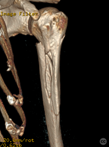 Anterolateral Helix plate - segmental proximal humerus fracture