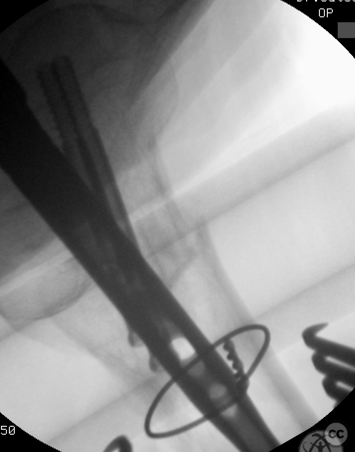 Multifragment intertrochanteric femur fracture with subtrochanteric ...
