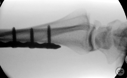 Revision of Galeazzi Fracture Dislocation with TFCC Repair and Ulnar ...