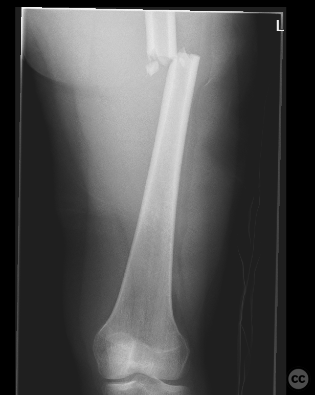 Simple transverse femoral shaft fracture