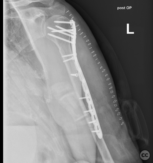 Anterolateral Helix plate - segmental proximal humerus fracture