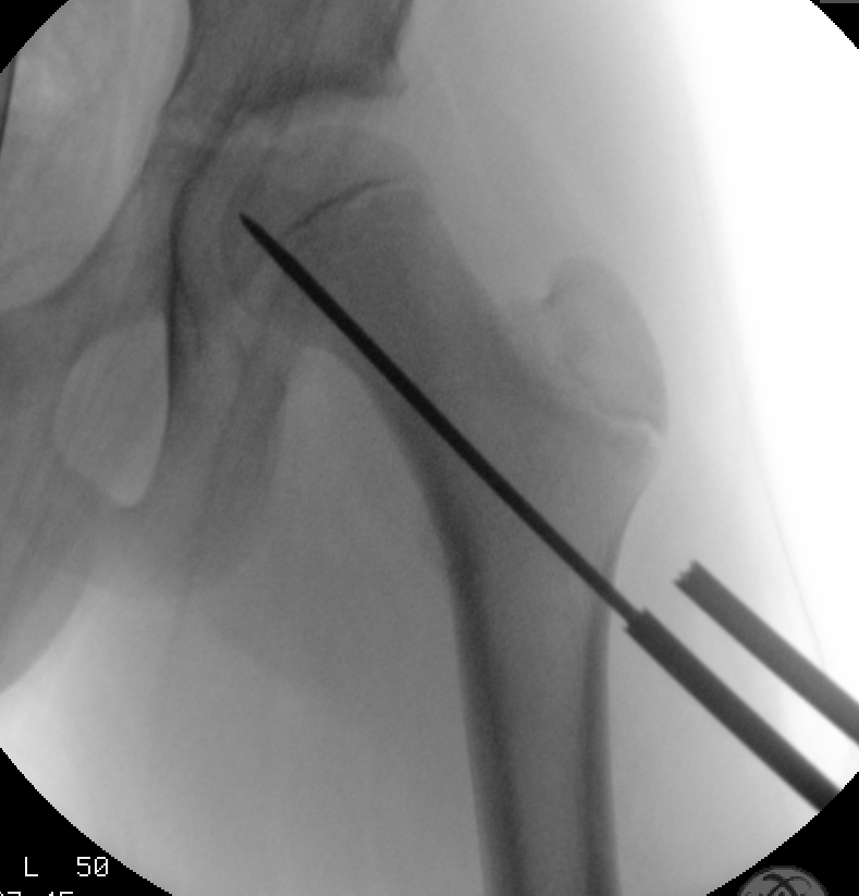 SCFE - Grade I - closed reduction and MIS osteosynthesis