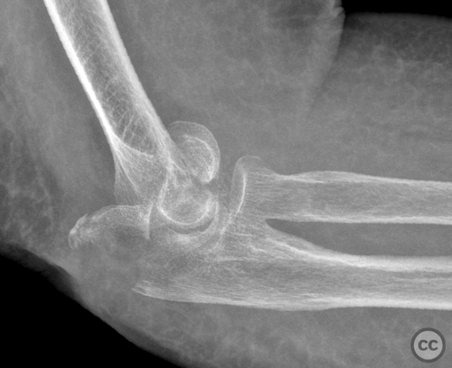 Transolecranon Dubberly 2B fracture dislocation
