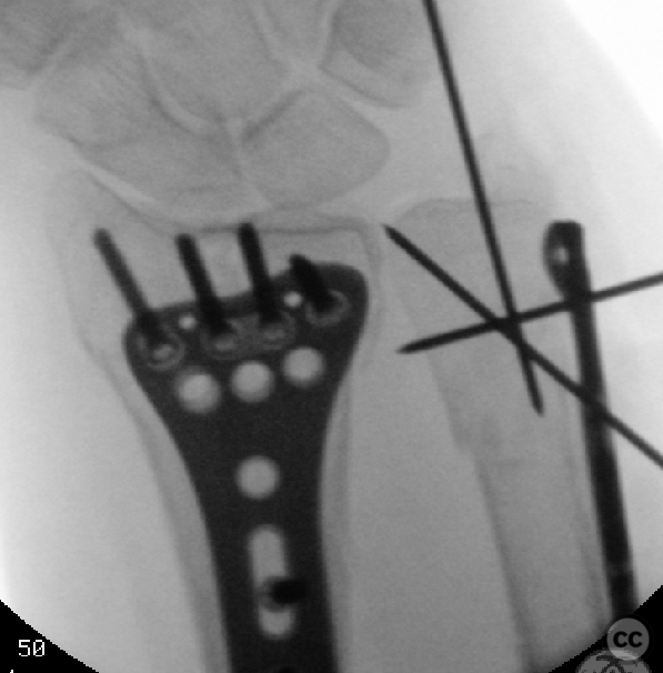 C3 distal radius fracture with distal ulna metaphyseal fracture