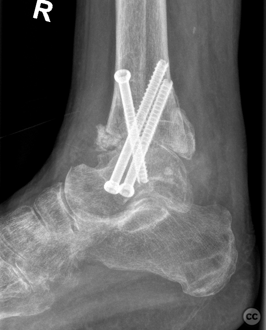 Failed pronation - external rotation (PER) ankle fracture dislocation