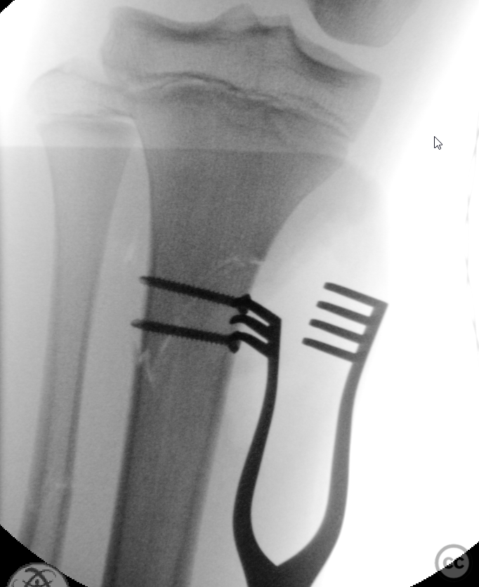 13yo proximal tibial diametaphyseal transition zone fracture
