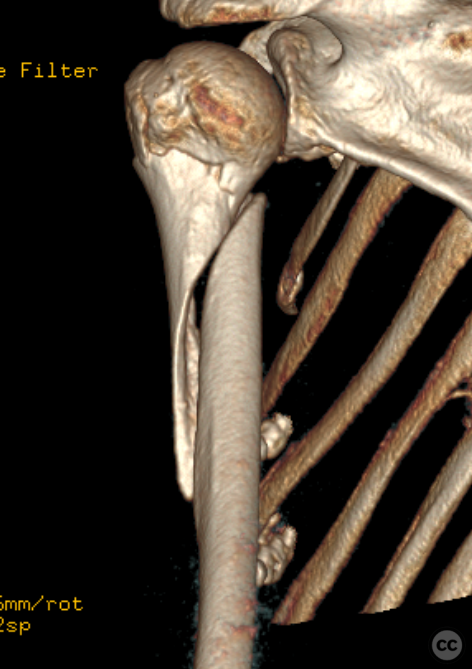 Anterolateral Helix plate - segmental proximal humerus fracture