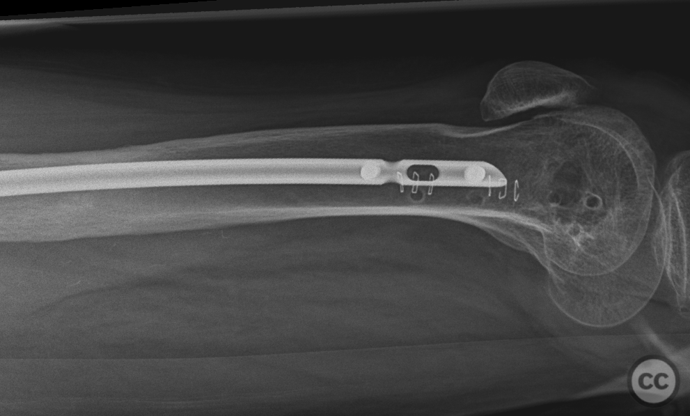 Multifragment intertrochanteric femur fracture with subtrochanteric ...