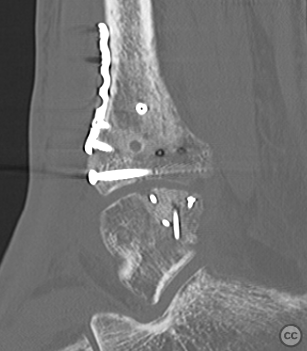 Anterior fracture dislocation with impression fracture of the articular ...