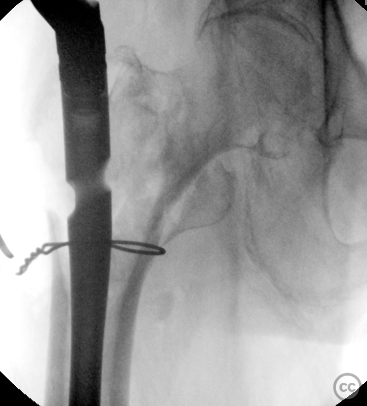 Failure of fixation - Gamma nail cut-out and arthroplasty revision
