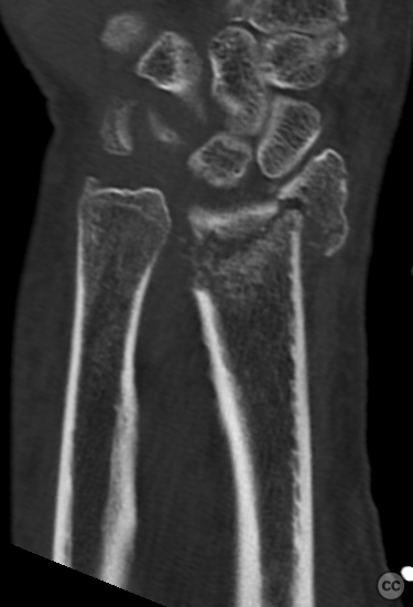 Complex comminuted and impacted distal radius fracture