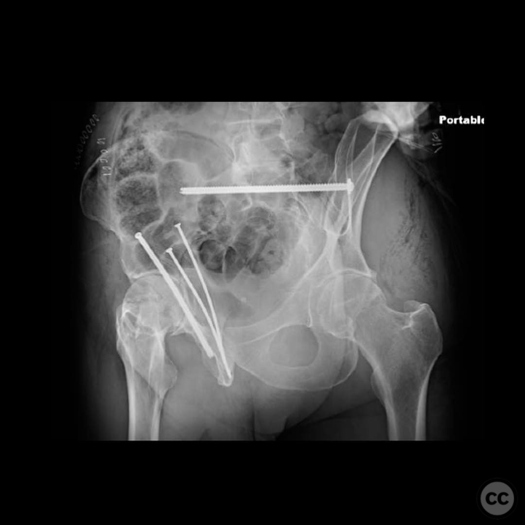Percutaneous Screw Fixation of Juxta Tectal Transverse Acetabular ...