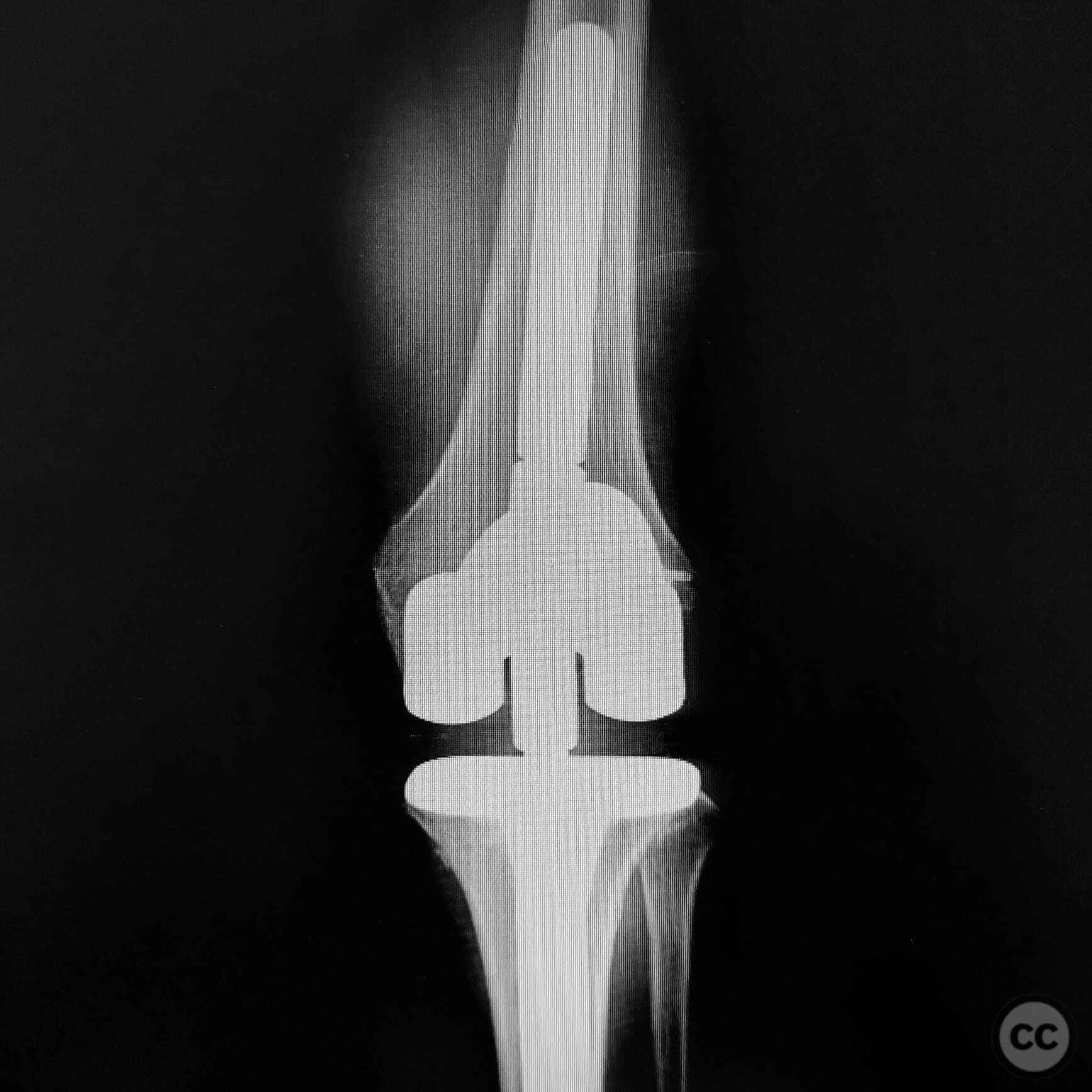Revision Rotating Hinge Knee Artroplasty revision-rotating-hinge-knee-artroplasty