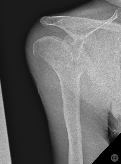 Subacute 2 part proximal humerus fracture
