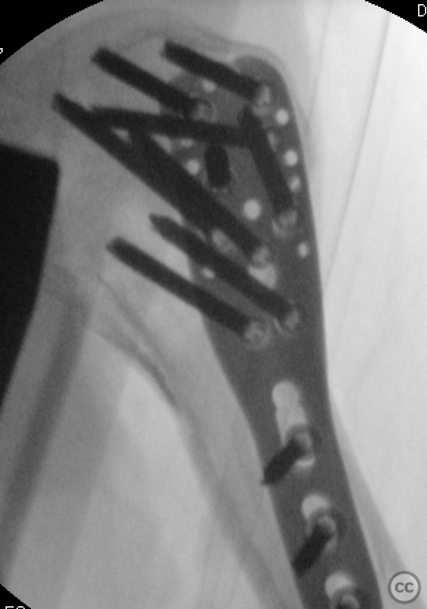 Impacted anatomical neck of humerus fracture with TM fragment