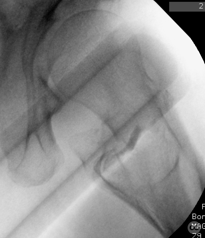 Multifragment intertrochanteric femur fracture with subtrochanteric ...