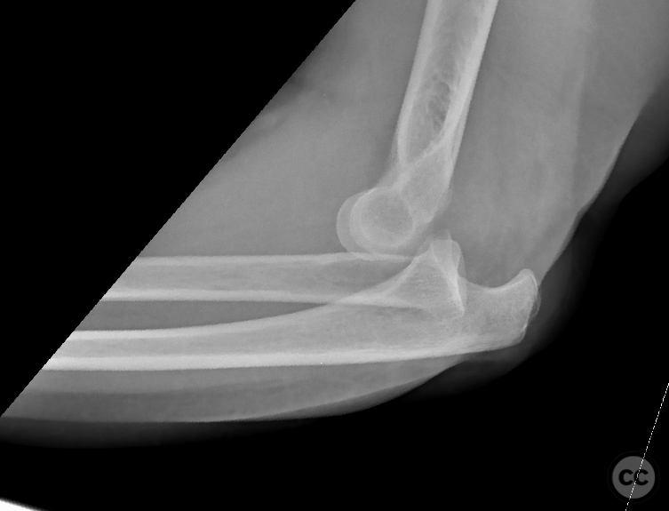 Subactue posterolateral elbow instability - LUCL internal brace ...