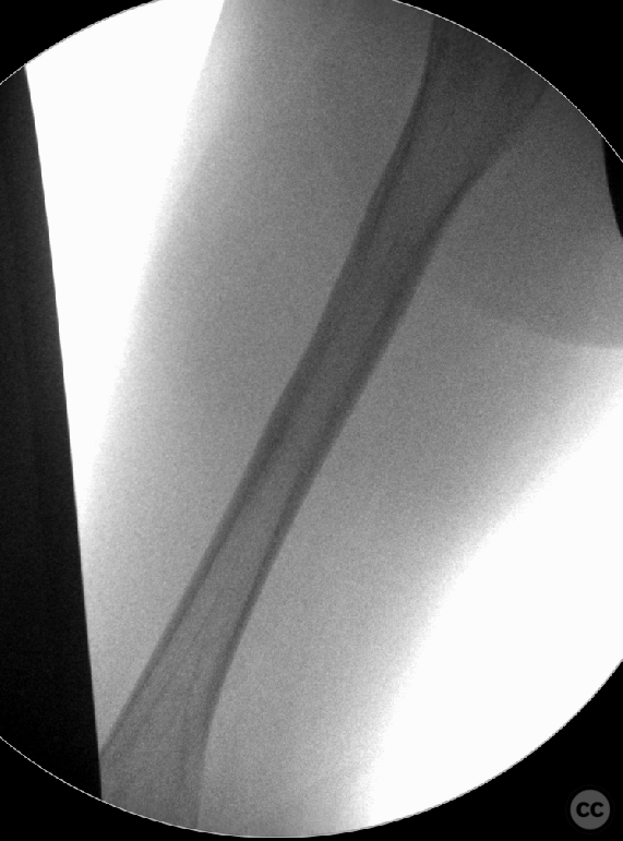 Pediatric Femoral Shaft Fracture Managed with Elastic Stable ...