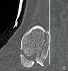 Mason and Molloy 2B Posterior Malleolar Fracture. Anterior collicular ...