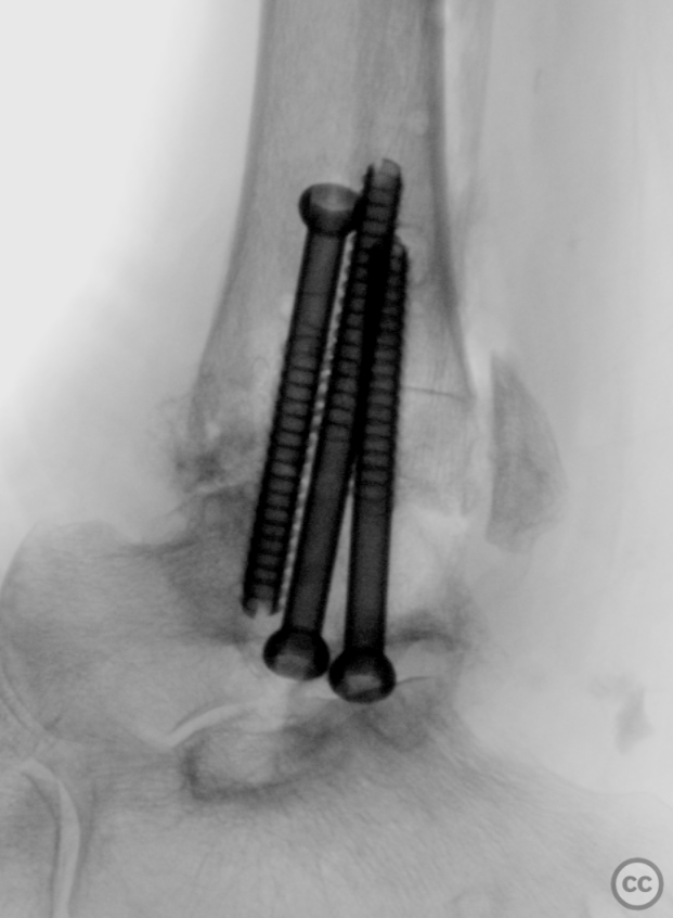 Failed pronation - external rotation (PER) ankle fracture dislocation