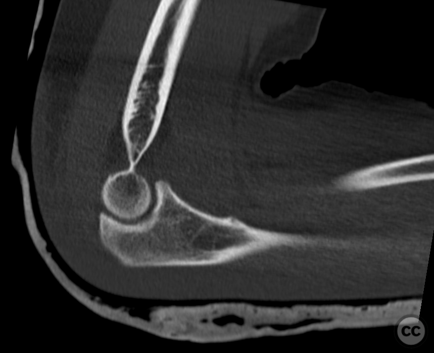 PMRI following elbow dislocation with pMCL insufficiency