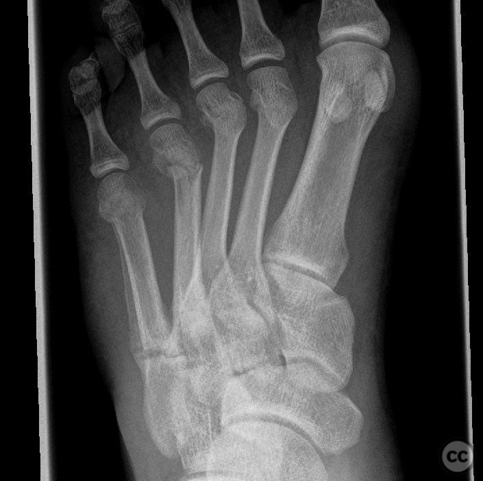 Nonunion MT5 Zone 2 plus acute subcapital MT2/3/4 fractures
