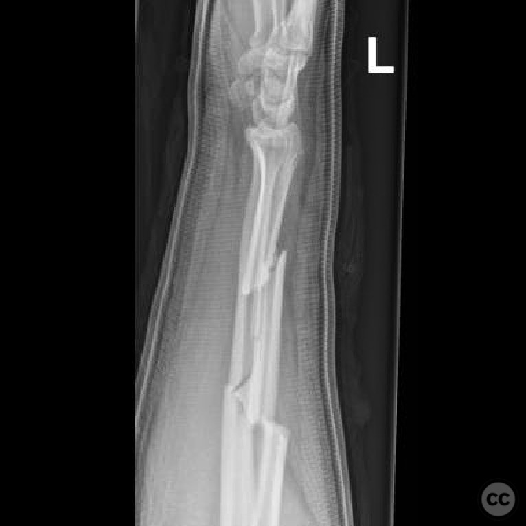 Segmental Both Bones Forearm Fracture in a Polytrauma Patient