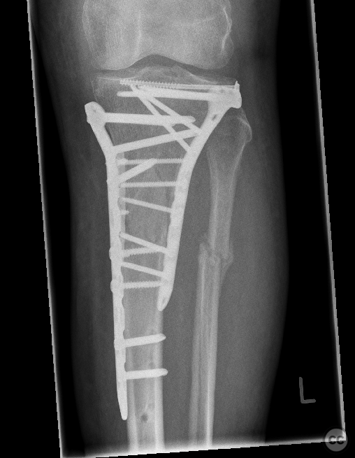 Combined tibial metaphysis and plateau fracture