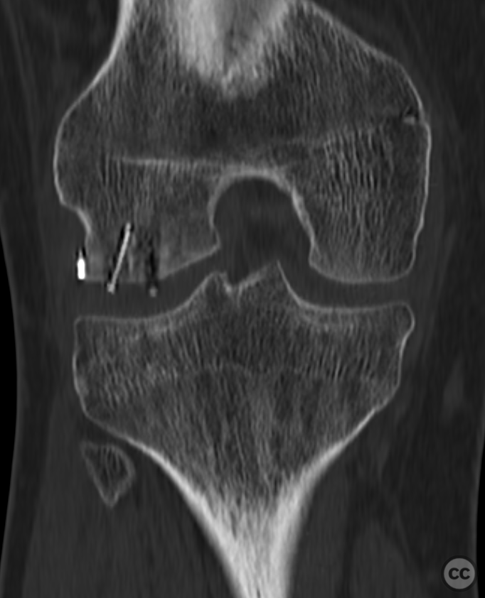 Destructive osteochondral fracture of the lateral femoral condyle ...