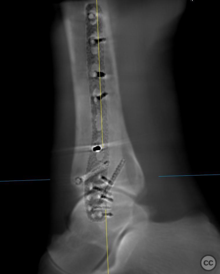Chaput tubercle fracture in an adult bimalleolar ankle fracture
