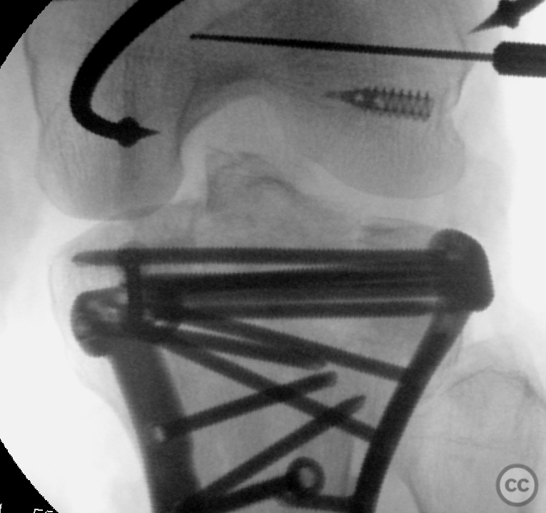 Schatzker 6 tibial plateau with lateral femoral epicondyle osteotomy