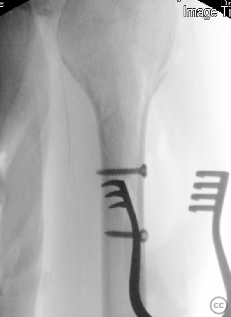Anterolateral Helix plate - segmental proximal humerus fracture