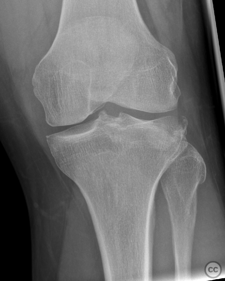 Lateral femoral epocondyle osteotomy and jail-screw fixation of the ...
