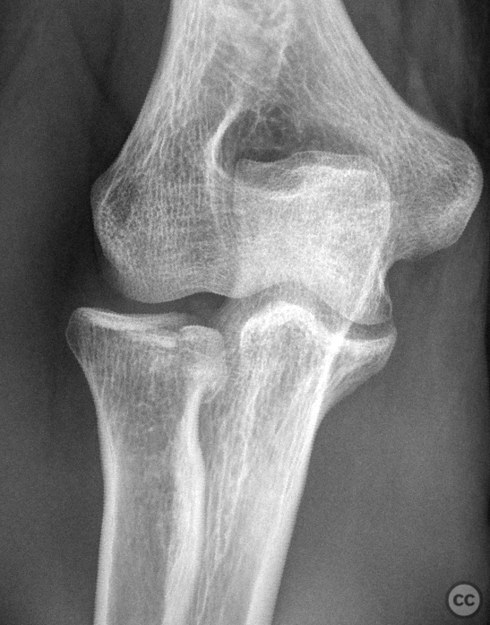Mason II Radial Head Fracture