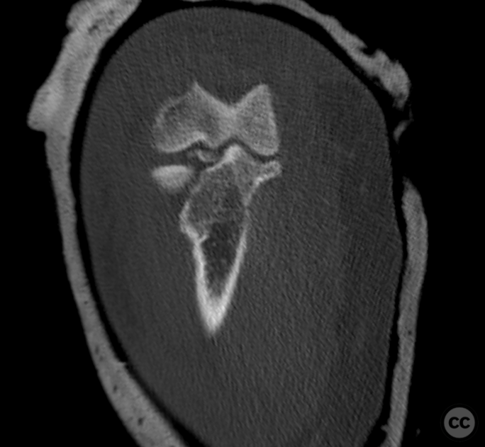 PMRI following elbow dislocation with pMCL insufficiency