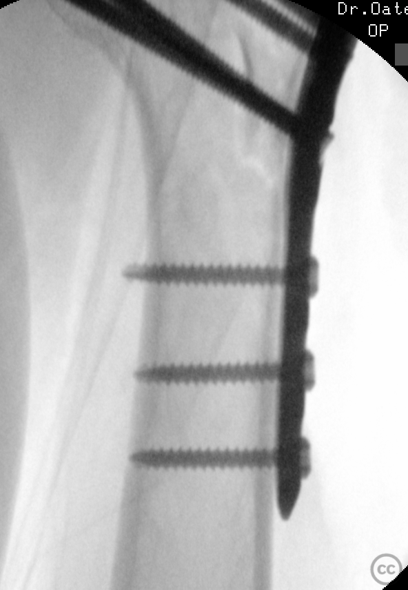 Impacted anatomical neck of humerus fracture with TM fragment