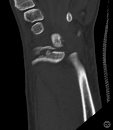 Operative Management of Chauffeur's Fracture with Intraarticular ...