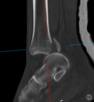 Failed pronation - external rotation (PER) ankle fracture dislocation