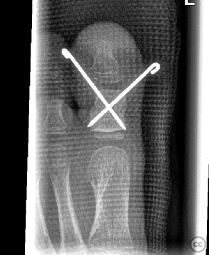 Proximal phalangeal Hallux fracture in a 5 year old