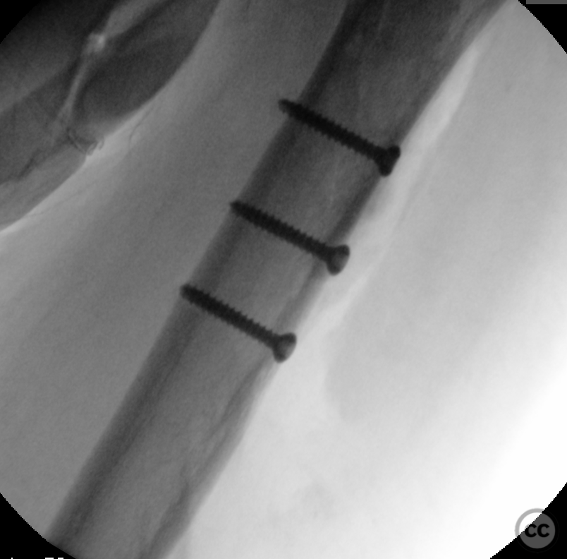 Prox 1/3 humeral shaft fracture with concomitant GH osteoarthritis