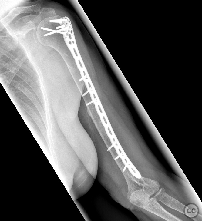 Aggregate lateral approach to a long segmental spiral humerus fracture
