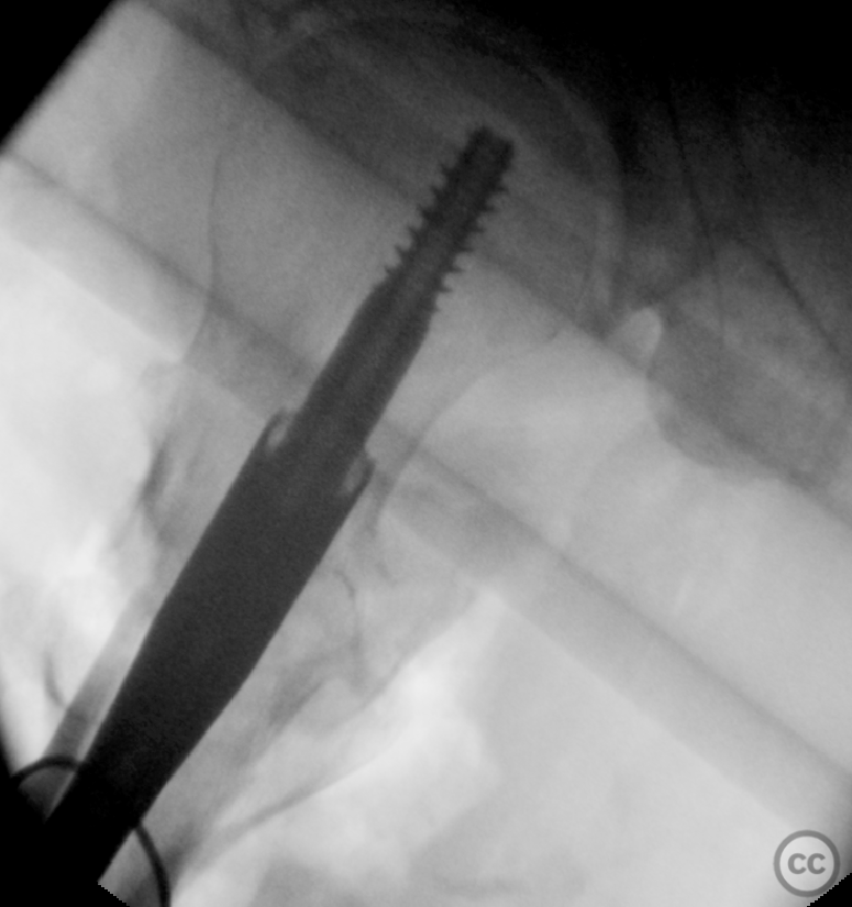 Hardware Failure of Primary Gamma Nail Osteosynthesis in ...