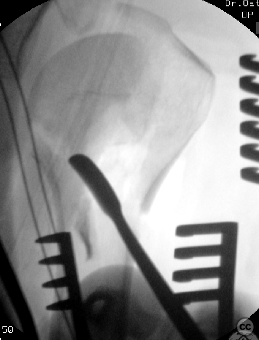 Impacted anatomical neck of humerus fracture with TM fragment