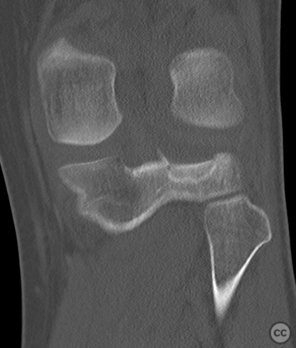 Apple-bite posterolateral corner and ACL / Eminentia Avulsion