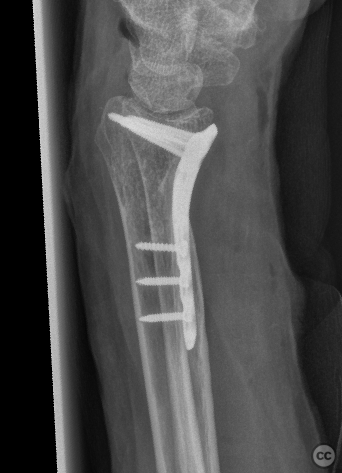 Volar Barton's volar rim fracture distal radius