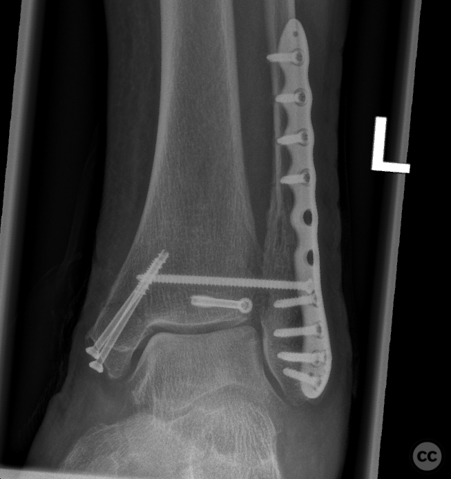 Pronation Abduction (PAb) ankle fracture with Mason 2A lateral plafond ...